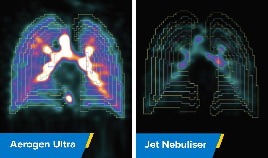 AEROGEN SOLO – WP Soluciones